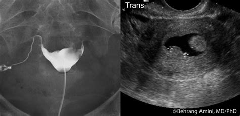Roentgen Ray Reader Intrauterine Filling Defect