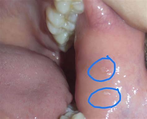 Are These Canker Sores Or Sign Of Trouble Aka Cancer Rcankersores