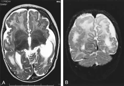 Case 6 A And B Axial And Coronal View T2 Weighted Images 3420168
