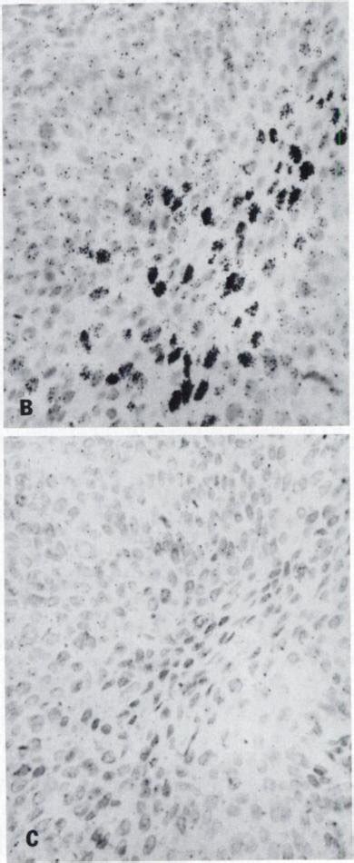Presence Of Hpv 16 Dna In Large Cell Nonkeratinizing Squamous Cell Download Scientific Diagram