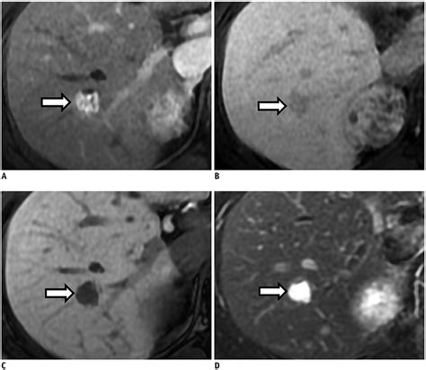 Atypical Appearance Of Hepatocellular Carcinoma And Its Mimickers How