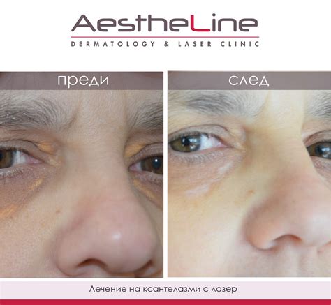 Преди След Aestheline