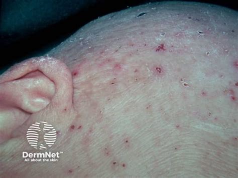 Itchy Skin Pruritus Causes And Treatment Options Hives Urticaria