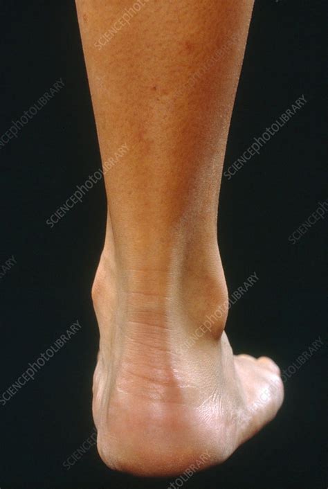 Female Ankle Stock Image C0034426 Science Photo Library