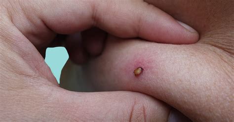 Tekenbeet Teek Herkennen Verwijderen Drs Leenarts