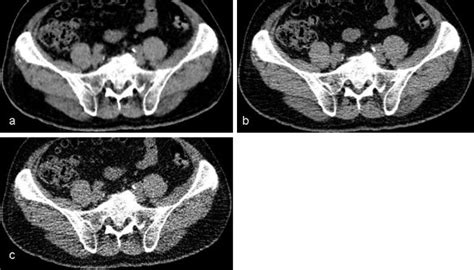 Noise And Streak Artifact Of Each Ct Image Axial Unenhanced Ct Images
