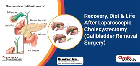 Recovery Diet And Life After Laparoscopic Cholecystectomy Gallbladder