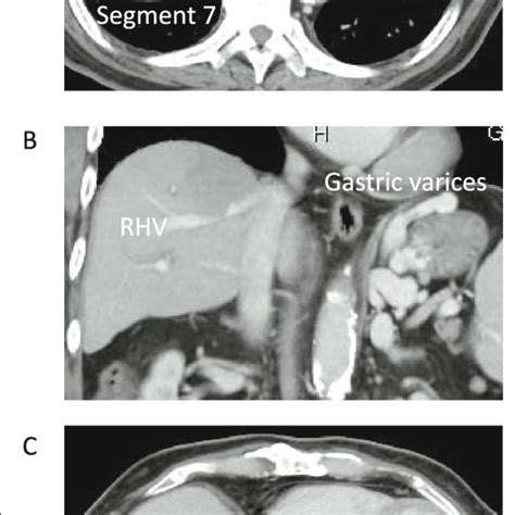 Ct Imaging Of Hcc Ct Showing The Tumor Located In Segment 7 Involving