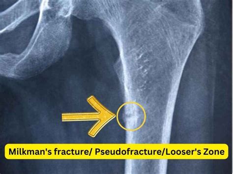 Osteomalacia Vs Osteoporosis Know The Difference My Endo Consult