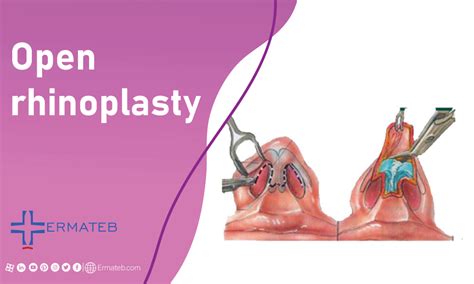 Different Types Of Rhinoplasty