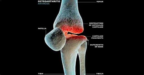 Osteoarthritis Symptoms Causes Types Risk And Treatments