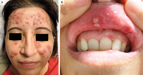 Papulopustular Rash In Behçets Disease Nejm
