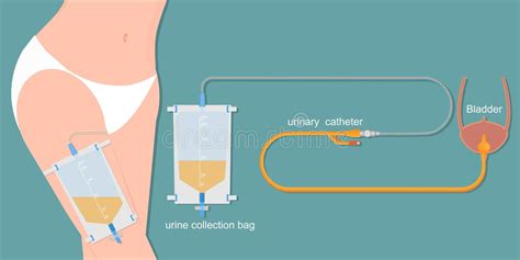 Urinary Drain Bag Stock Illustrations 78 Urinary Drain Bag Stock