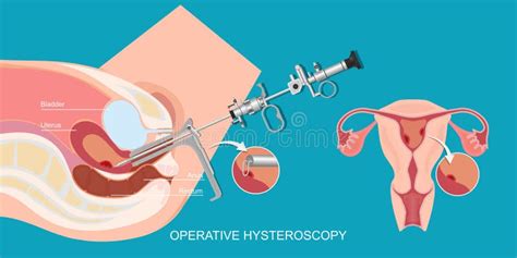 Operative Hysteroscopy Is A Minimally Invasive Gynecological Procedure