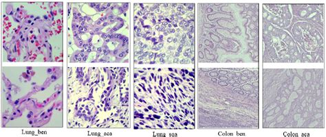 Figure From Classification Of Lung And Colon Cancer Histopathological
