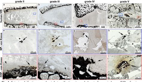 Figure 1 From Ages Induce Ectopic Endochondral Ossification In Intervertebral Discs Semantic