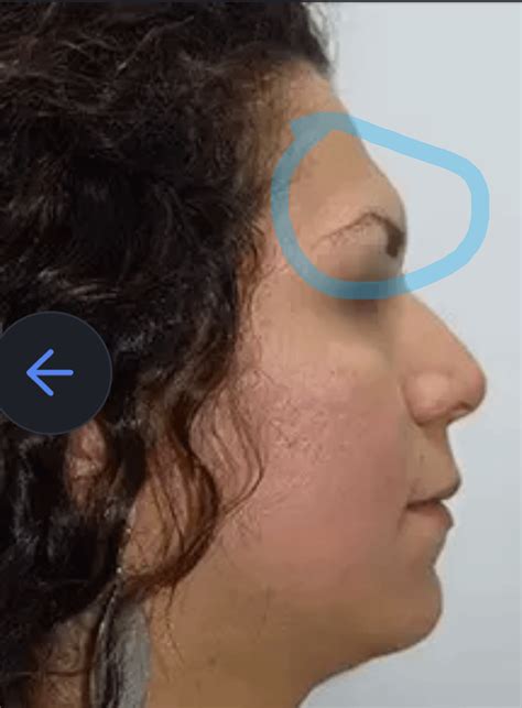 Is This Eye Brow Ridge Bump Caused By Recessed Maxilla I Swear Most Of