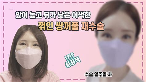 앞이 높고 뒤가 낮은 어색한 꺾인 쌍꺼풀 재수술 Youtube
