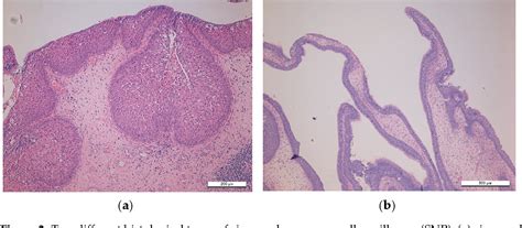 Figure 2 From Hpv Associated Benign Squamous Cell Papillomas In The