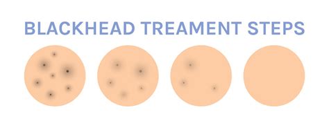 인간 피부에 얼굴 블랙 헤드 문제 피부 치료 걸음 더럽고 건강한 맑은 피부 전후 컬러 사실적인 스타일 흰색 배경 뷰티 및 메디컬 디자인을 위한 벡터 일러스트 레이 션 각질