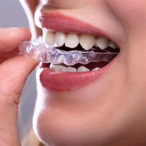 Clear Aligners Adelaide — Prospective Smiles