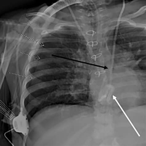 Intraoperative Photos Of A Pericardial Window With A Bactiseal Catheter Download Scientific