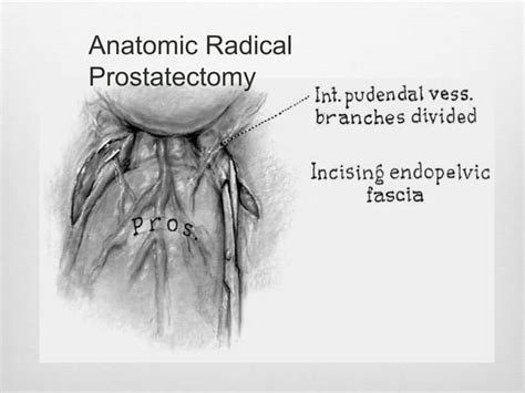 Prostate Clinical Anatomy As Applied To Prostate Cancer Pptx