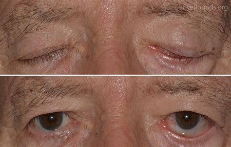 Facial Nerve Palsy Ocular Complications And Management