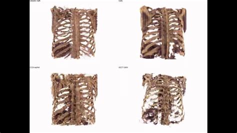 Unaligned 2d To 3d Translation With Conditional Vector Quantized Code