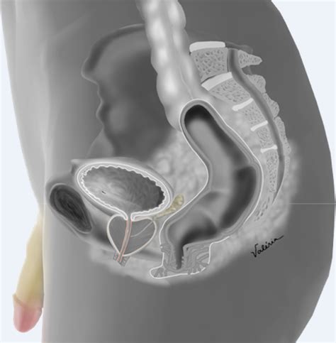 Prostatic Artery Embolization Indications Preparation Techniques Imaging Evaluation