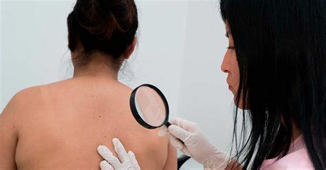 Cáncer De Piel Aprende A Identificar Señales De Riesgo De La Enfermedad