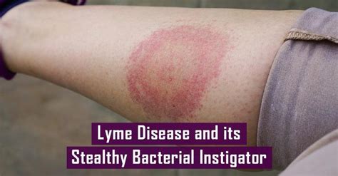 Unveiling Lyme Understanding The Disease And Its Impact Medsynapse