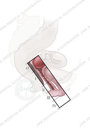 Degrees Of Prolapse JMK Med Illustration