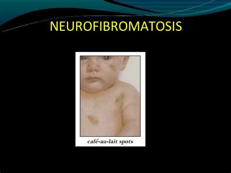 Neurofibromatosis O Enfermedad De Von Recklinghausen