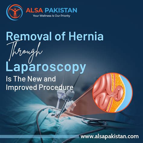 Muhammad Mohsin On Linkedin Laparoscopic Needle Herniotomy For