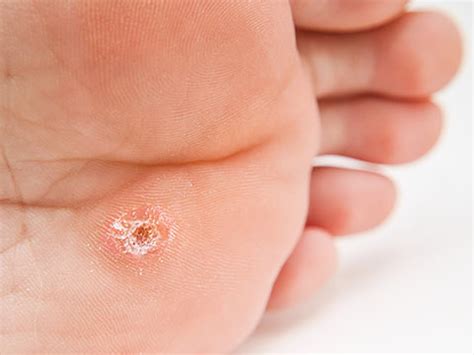 Whats The Difference Between A Corn And A Callus Dr Howard Green