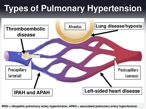 Pulmonary Arterial Hypertension In Rural Communities Early Diagnosis