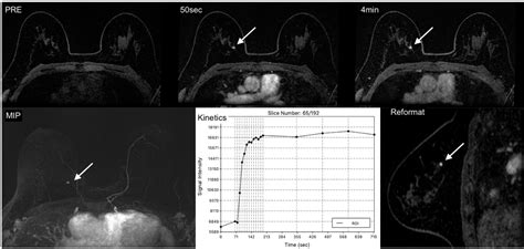 figure 2 disco mri only visible 4mm invasive ductal carcinoma grade