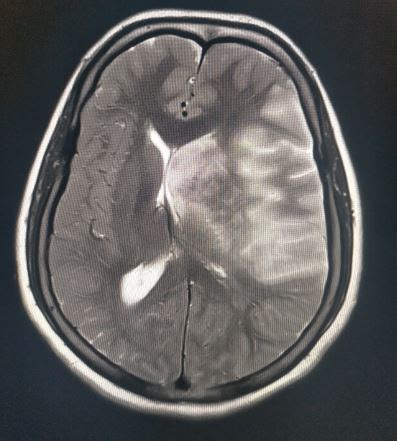 Figure Subfalcine Herniation Contributed By Sunil Munakomi MD StatPearls NCBI Bookshelf