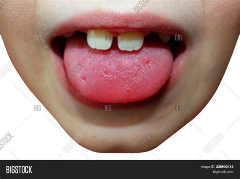 Stomatitis Tongue