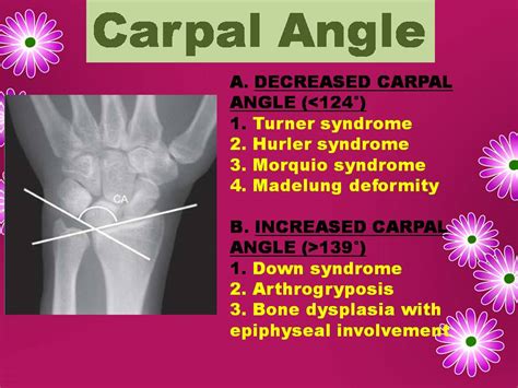 Carpal Angle Metacarpal Sign Radiology Classroom Facebook