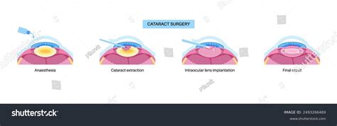 Cataract Surgery Process Anesthesia Incision Cataract Stock Vector