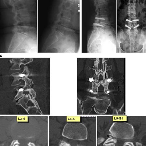 bone fusion grade classification download scientific diagram
