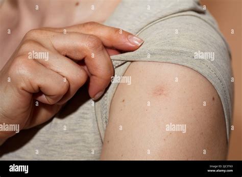 Smallpox Vaccine Scar Shoulder