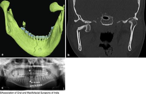 17 A 3d Reconstruction Of The Preoperative Ct Scan Showing The Medial