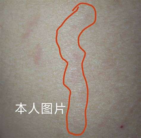 甜野猫属性 M on Twitter 偶然间发现屁股上长了生长纹短条状红色的很丑 图一是本人的屁股图二是网图 很不解为什么有的人非常胖也没有生长纹而我并不胖而且也没有增加