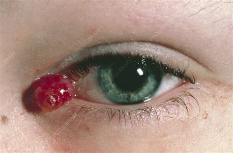 Pyogenic Granuloma Eye Treatment