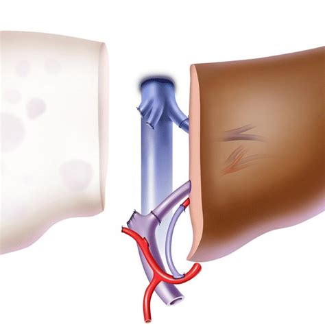 Step 1 Left Hemihepatectomy In The Recipient The Resection Plane Download Scientific Diagram