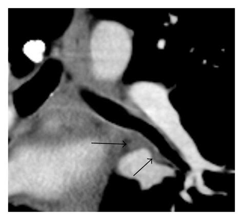 Normal Pericardial Recesses May Be Confused With Pathology A