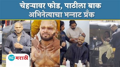 Shiv Thakare चेहऱ्यावर फोड पाठीला बाक मराठमोळ्या अभिनेत्याचा भन्नाट